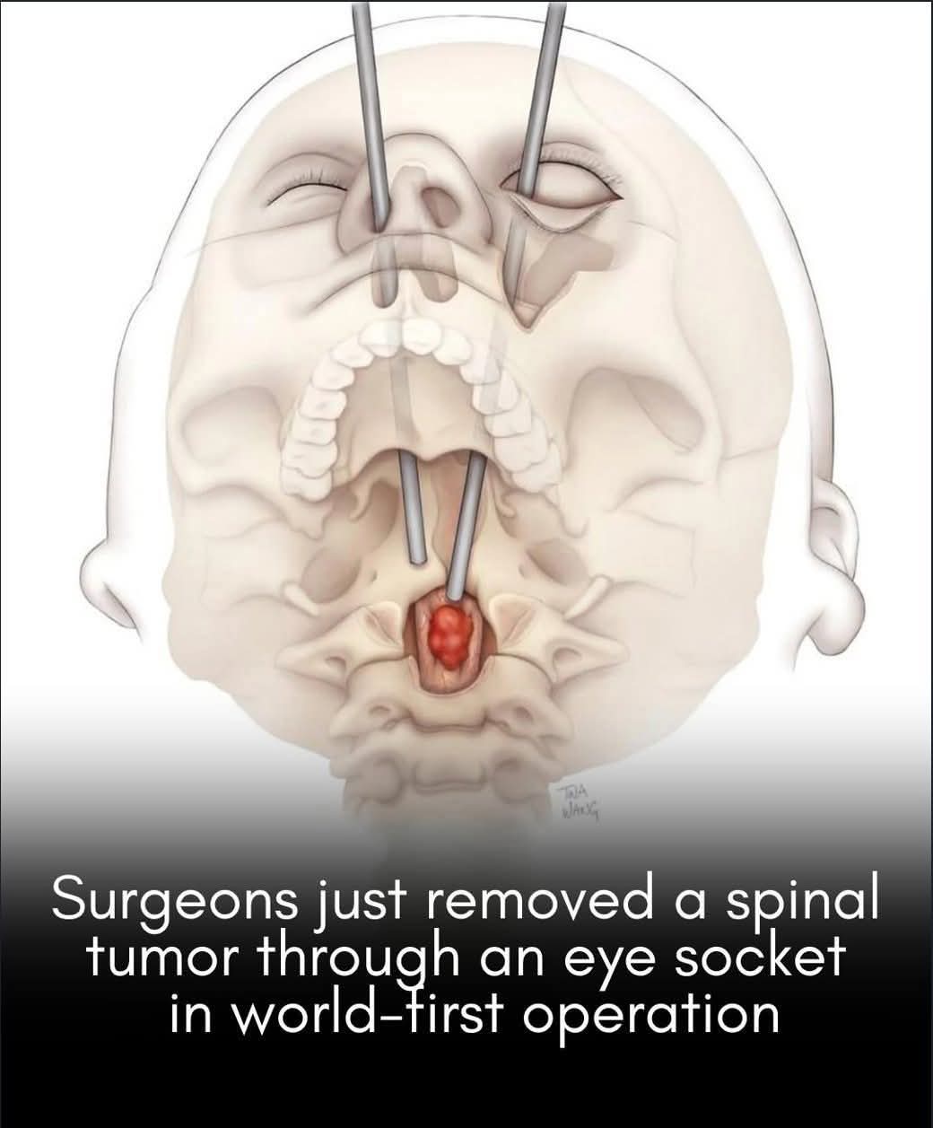 World’s First: Surgeons Remove Spinal Tumor Through Eye Socket ...